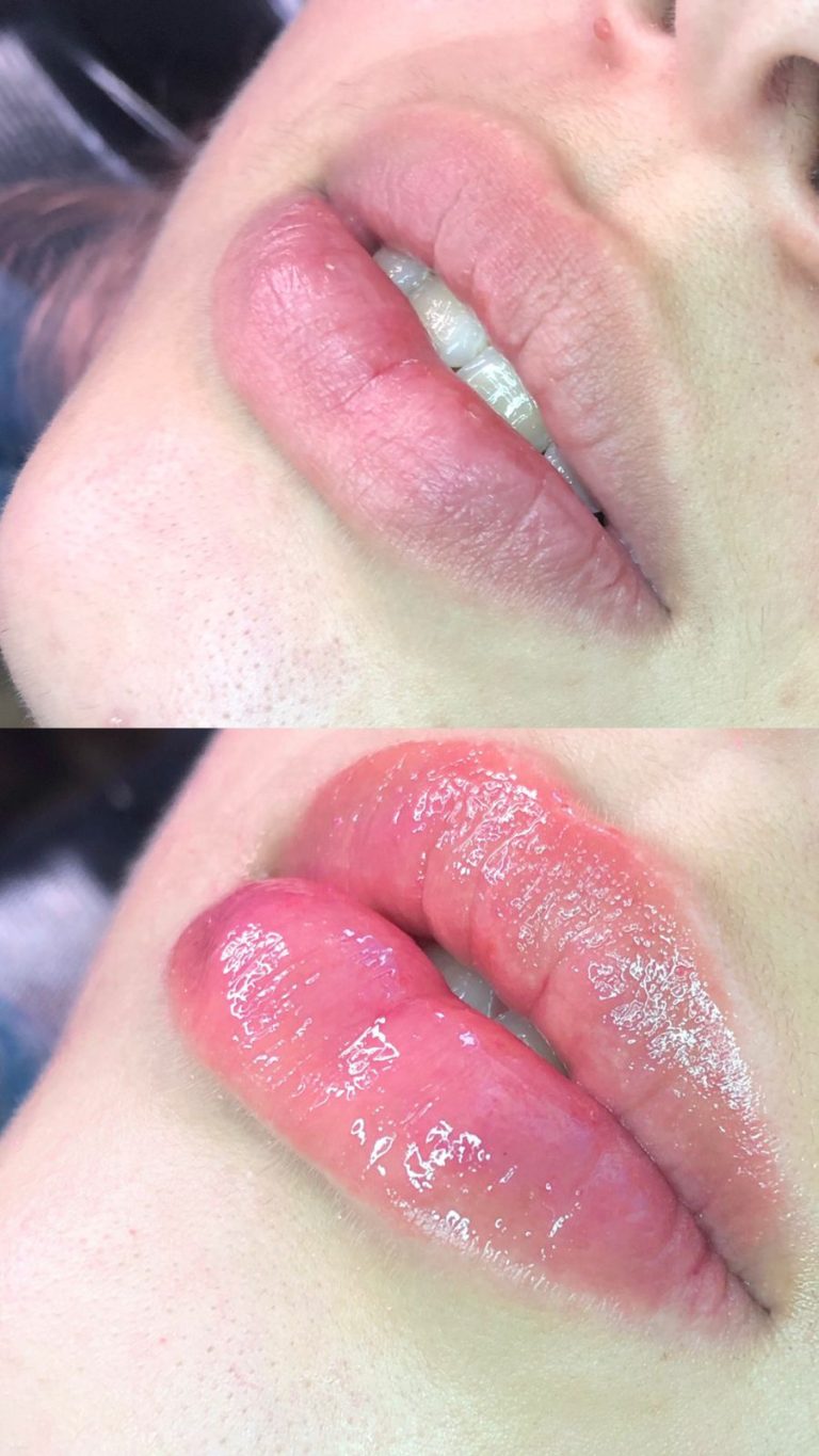 Hidragloss: tratamento brasileiro nutre e rejuvenesce os lábios