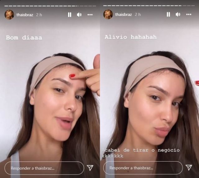 Ex-BBB Thais Braz mostra a testa pela primeira vez após cirurgia