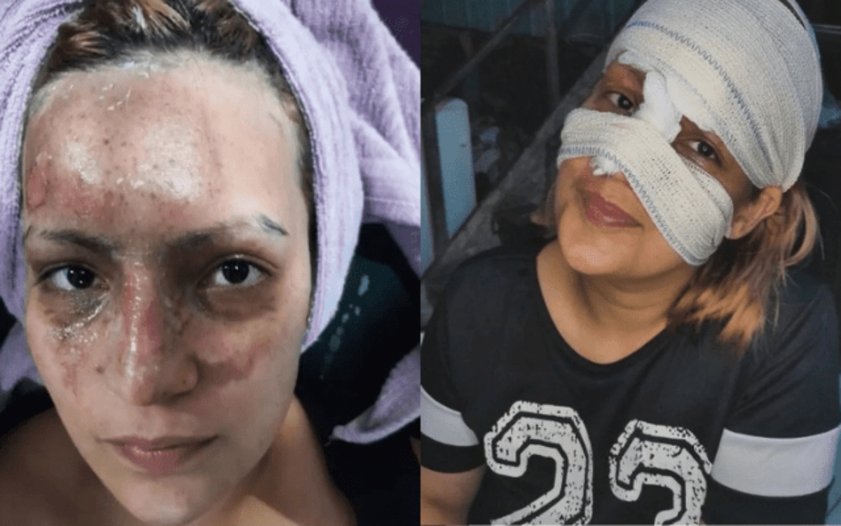 Rosto Queimado Médico Que Realizou Procedimento Estético Que Queimou